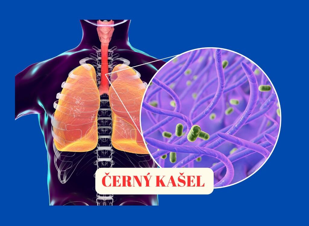 Černý kašel - měsíční přehled výskytu v ČR - SZÚ | Oficiální web ...