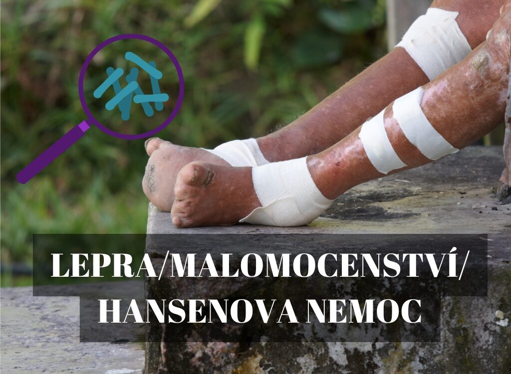 Vzácný případ lepry v Irsku připomíná, že nemoc stále nevymizela - SZÚ ...